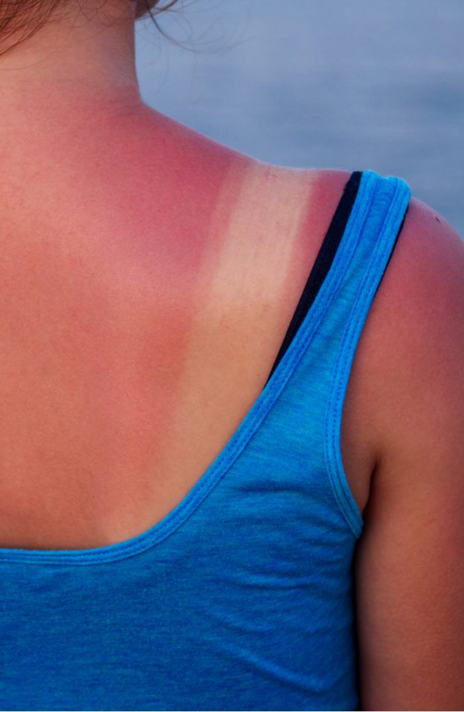 How To Care For Sunburned Skin – Blair Skincare